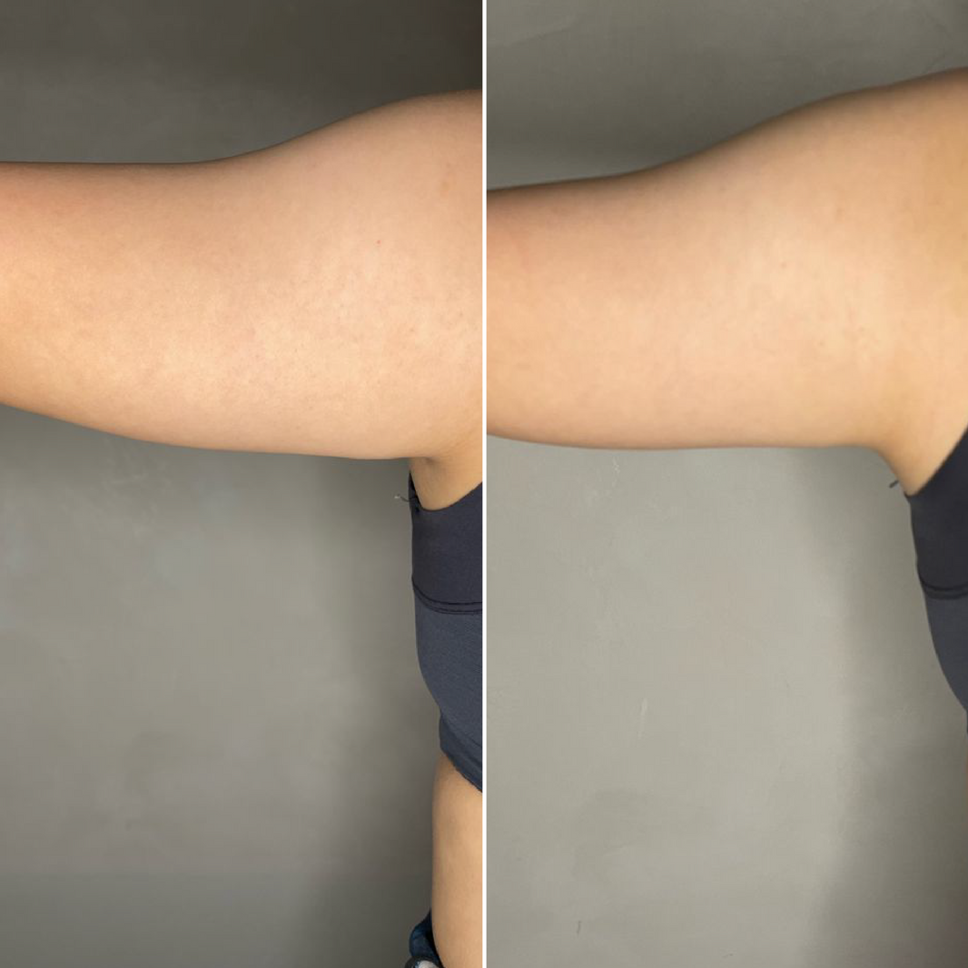 EMSHAPE Body Sculpting and Fat Reduction Treatment | Curvena Malaysia