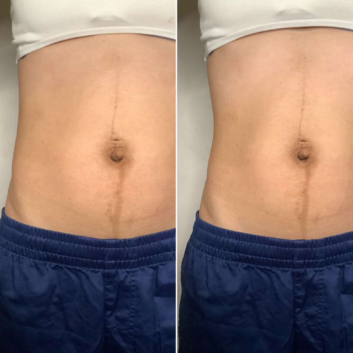 EMSHAPE Body Sculpting and Fat Reduction Treatment | Curvena Malaysia