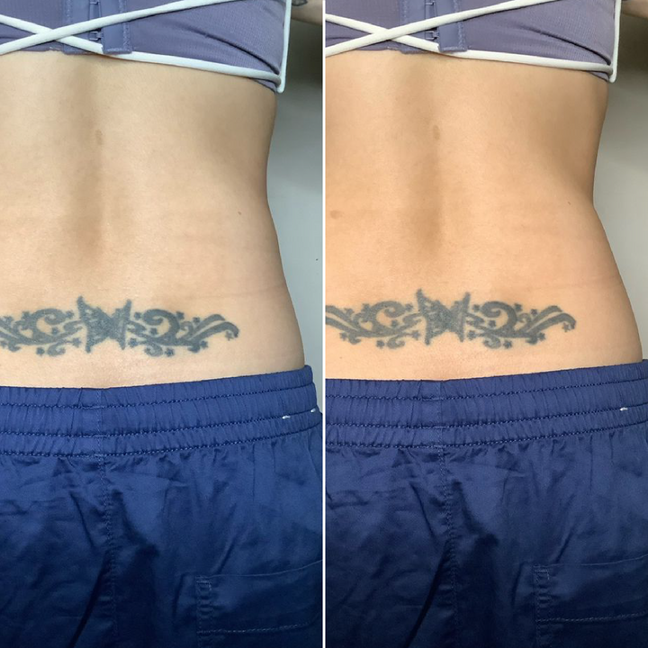 EMSHAPE Body Sculpting and Fat Reduction Treatment | Curvena Malaysia